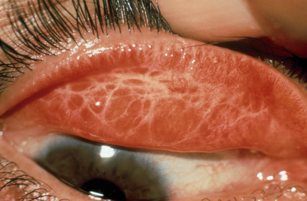 WHO Confirms Eradication Of Trachoma In Morocco | Business Post Nigeria